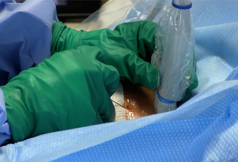 PICC Excellence - PICC Excellence is the leader in vascular access