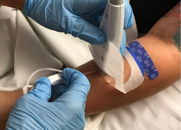 Deep Vein Thrombosis and How it Affects Vascular Access - PICC Excellence